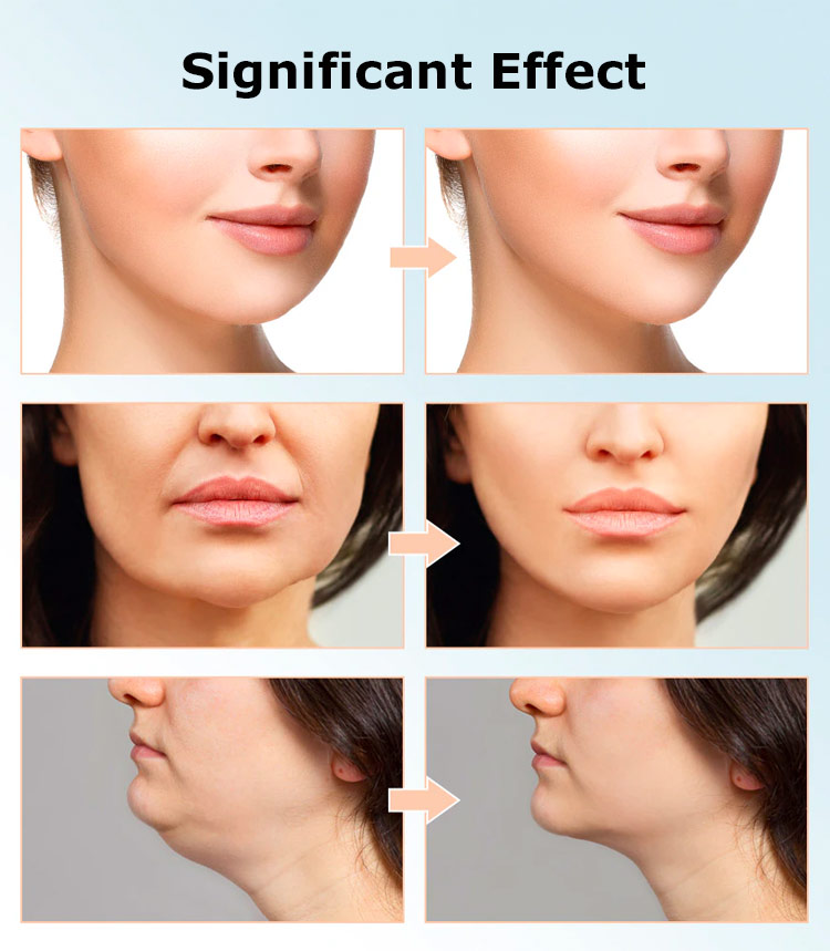 V-Face Lifting Device-EMS Massage Double Chin V-shaped Face Slimming